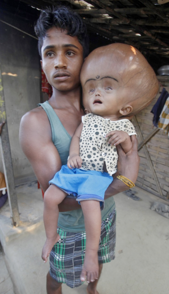 Roona Begum, una niña india con la cabeza hinchada debido a la hidrocefalia